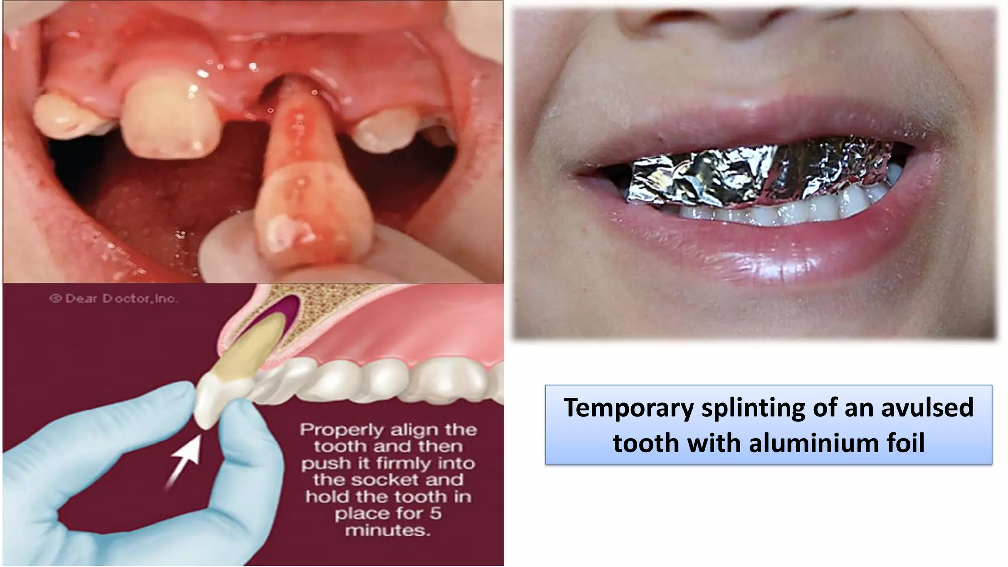 tooth avulsion.pdf