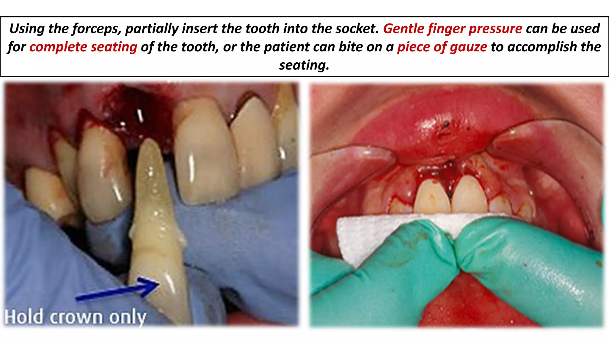 tooth avulsion.pdf