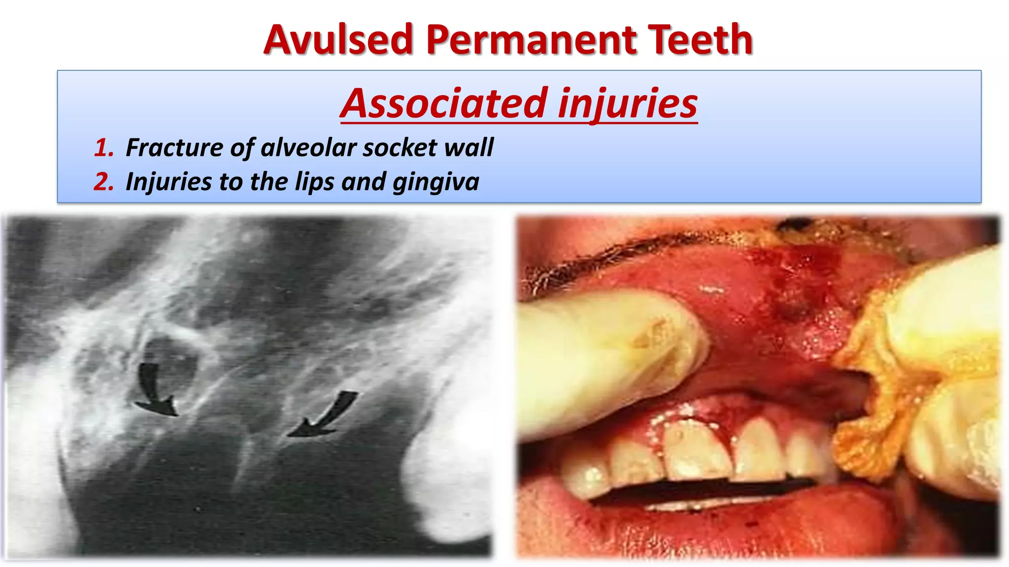 tooth avulsion.pdf