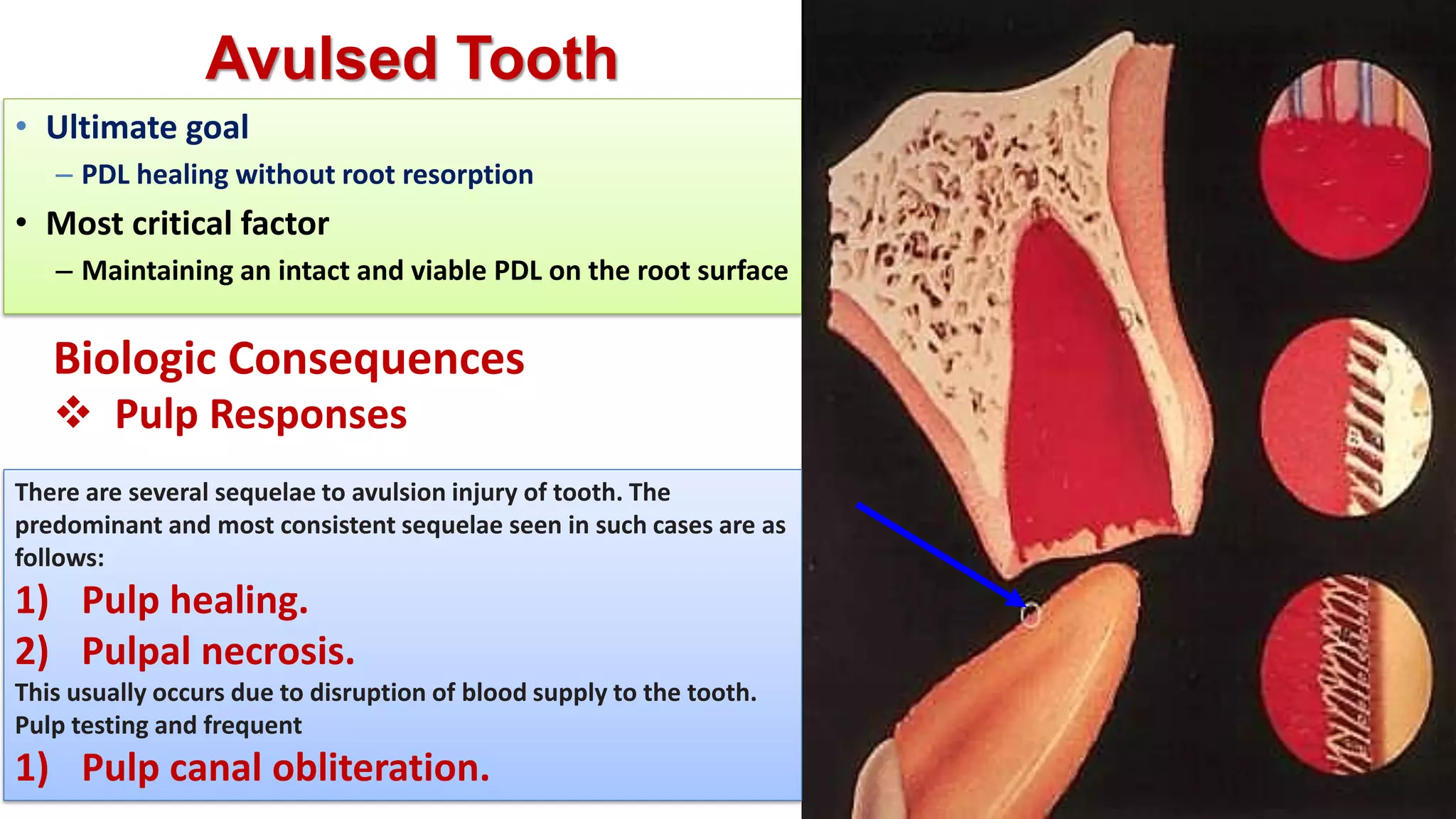 tooth avulsion.pdf