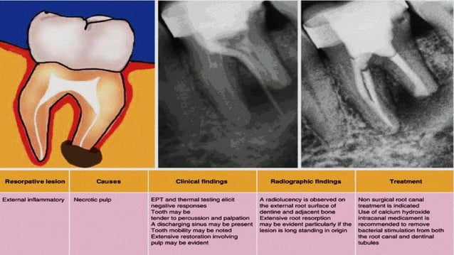 tooth avulsion.pdf