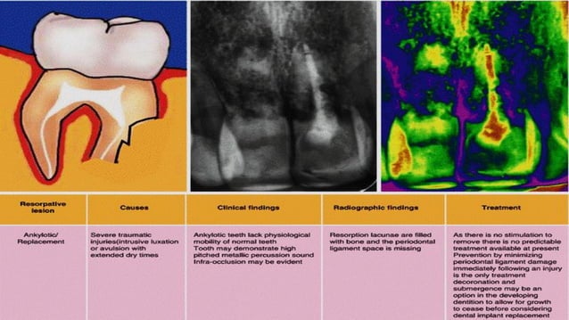 tooth avulsion.pdf