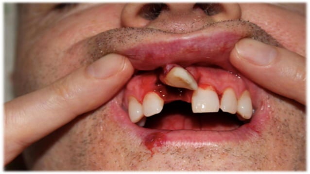 tooth avulsion.pdf