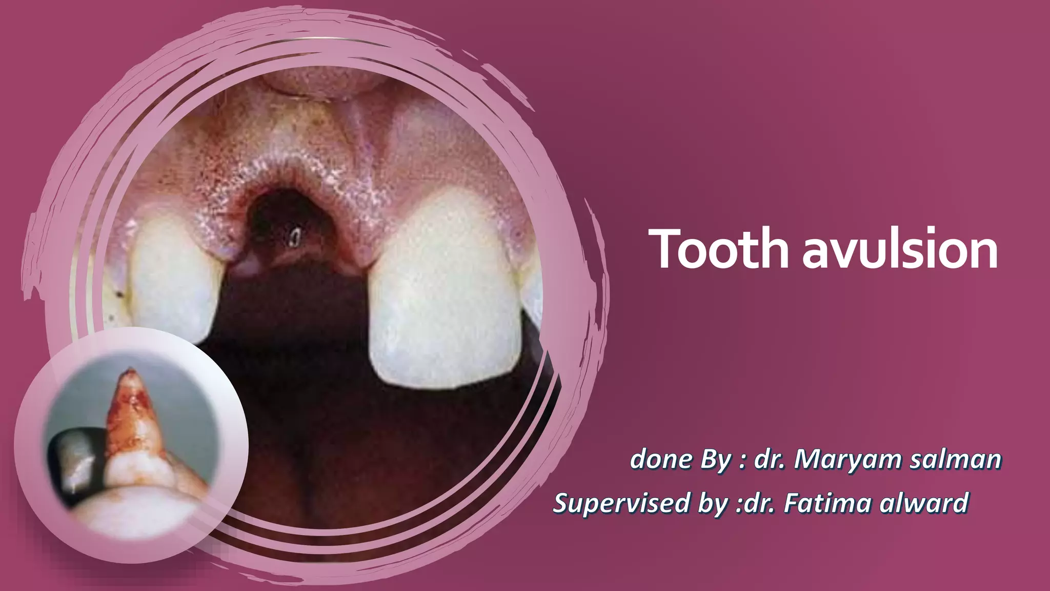 Tooth avulsion dr.maryam salman | PPTX | Injuries | Diseases and Conditions
