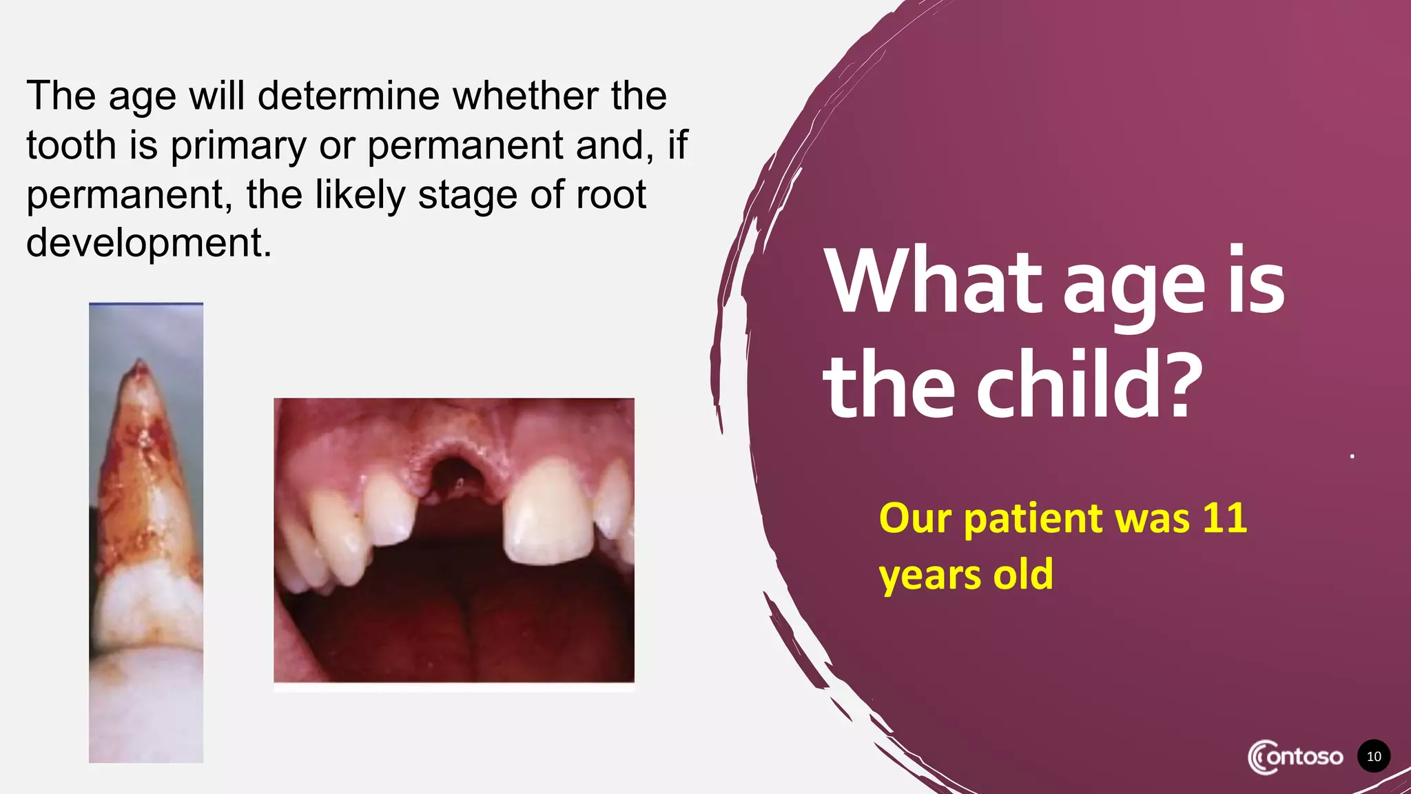 Tooth avulsion dr.maryam salman | PPTX | Injuries | Diseases and Conditions