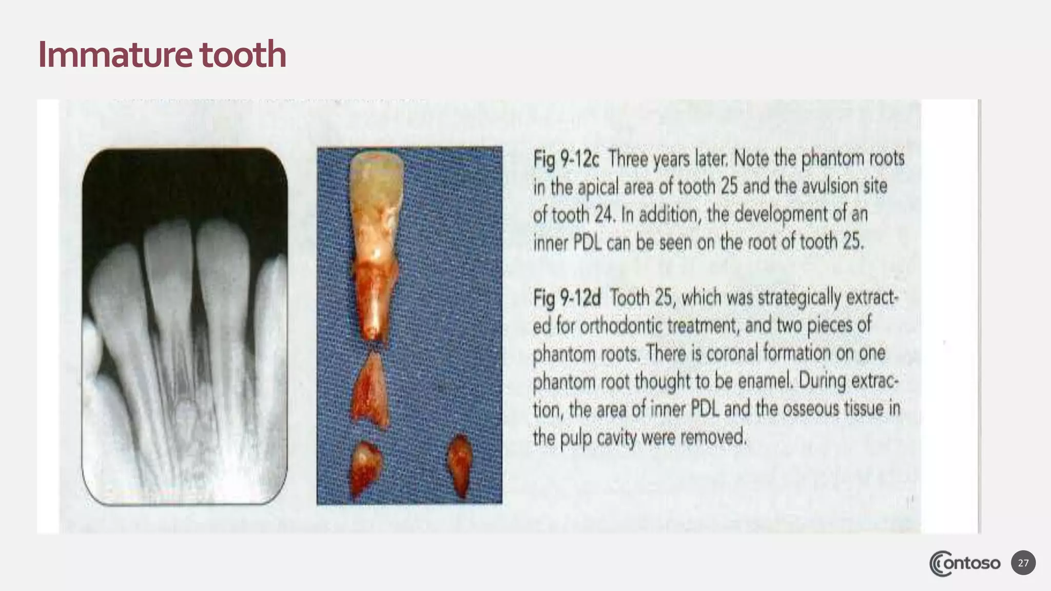 Tooth avulsion dr.maryam salman | PPTX
