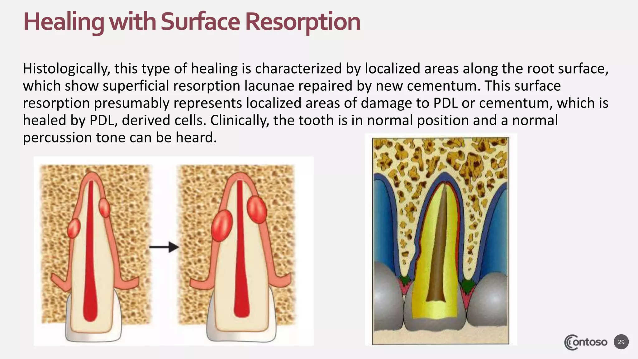Tooth avulsion dr.maryam salman | PPTX