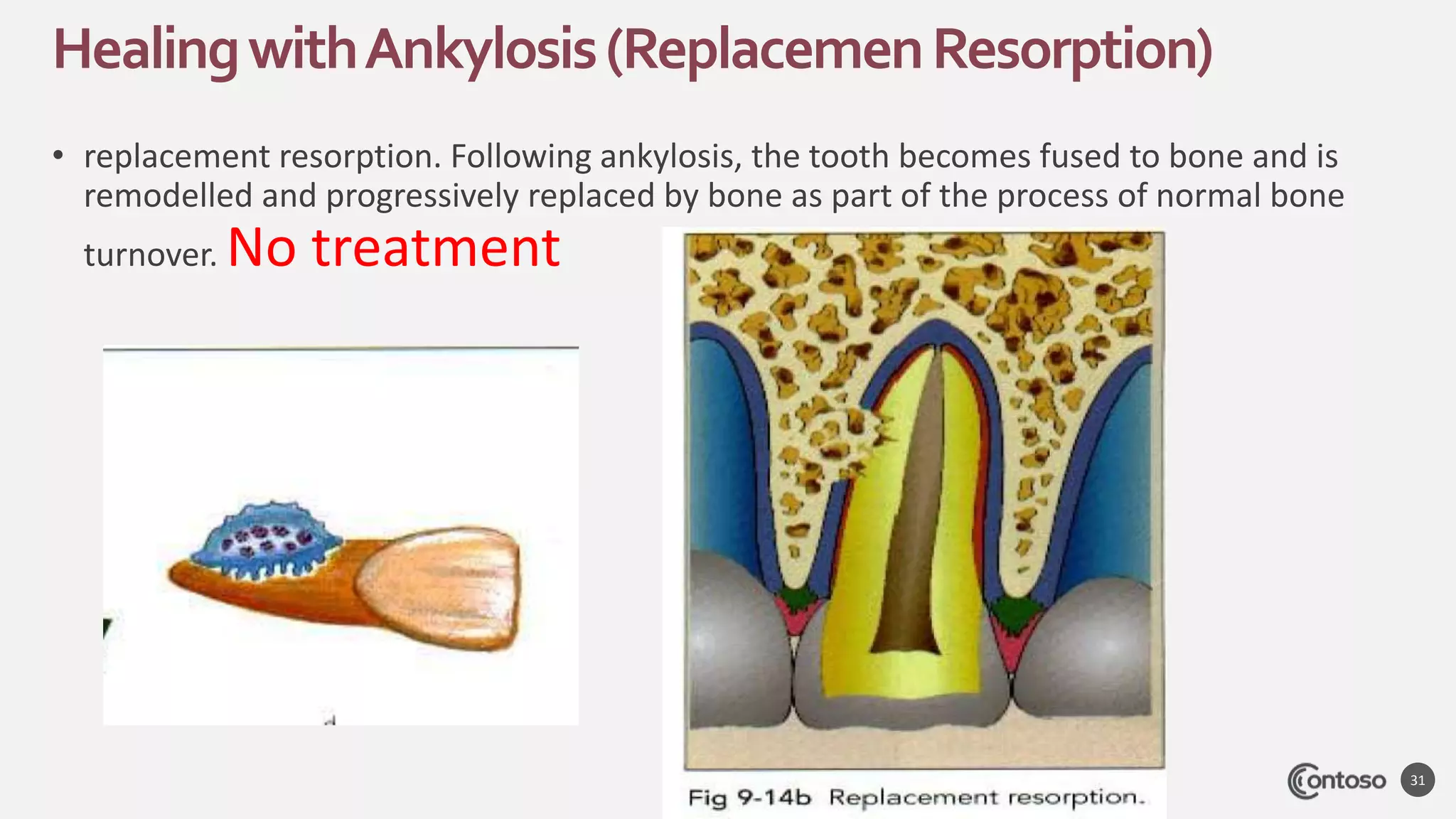 Tooth avulsion dr.maryam salman | PPTX