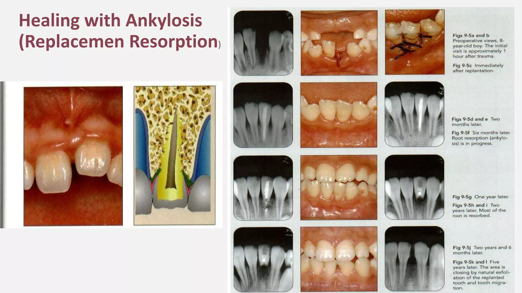Tooth avulsion dr.maryam salman | PPTX | Injuries | Diseases and Conditions