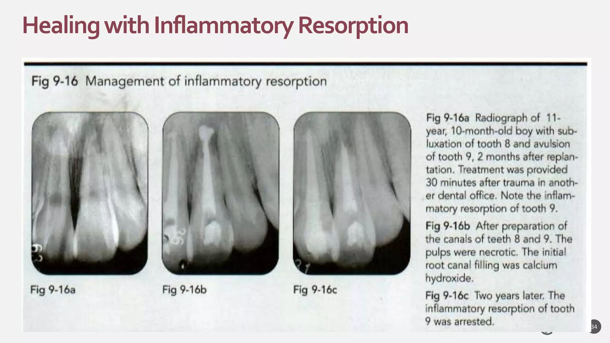 Tooth avulsion dr.maryam salman | PPTX