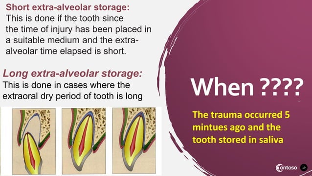 Tooth avulsion dr.maryam salman | PPT