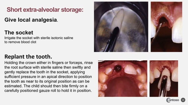 Tooth avulsion dr.maryam salman | PPT