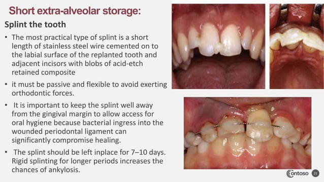 Tooth avulsion dr.maryam salman | PPT