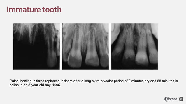Tooth avulsion dr.maryam salman | PPT