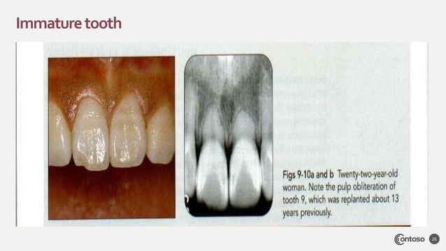Tooth avulsion dr.maryam salman | PPT