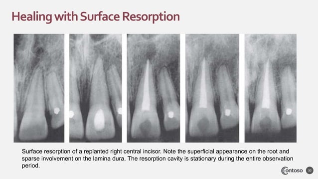 Tooth avulsion dr.maryam salman | PPT