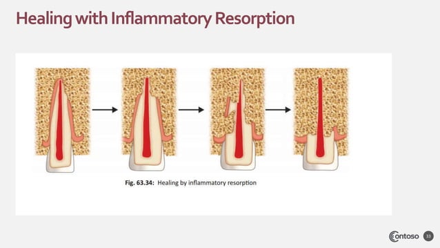 Tooth avulsion dr.maryam salman | PPT