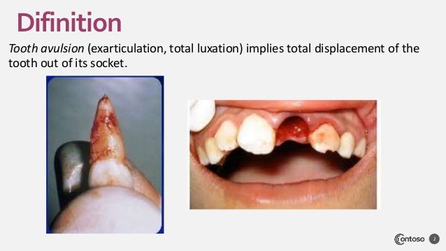 Tooth avulsion dr.maryam salman