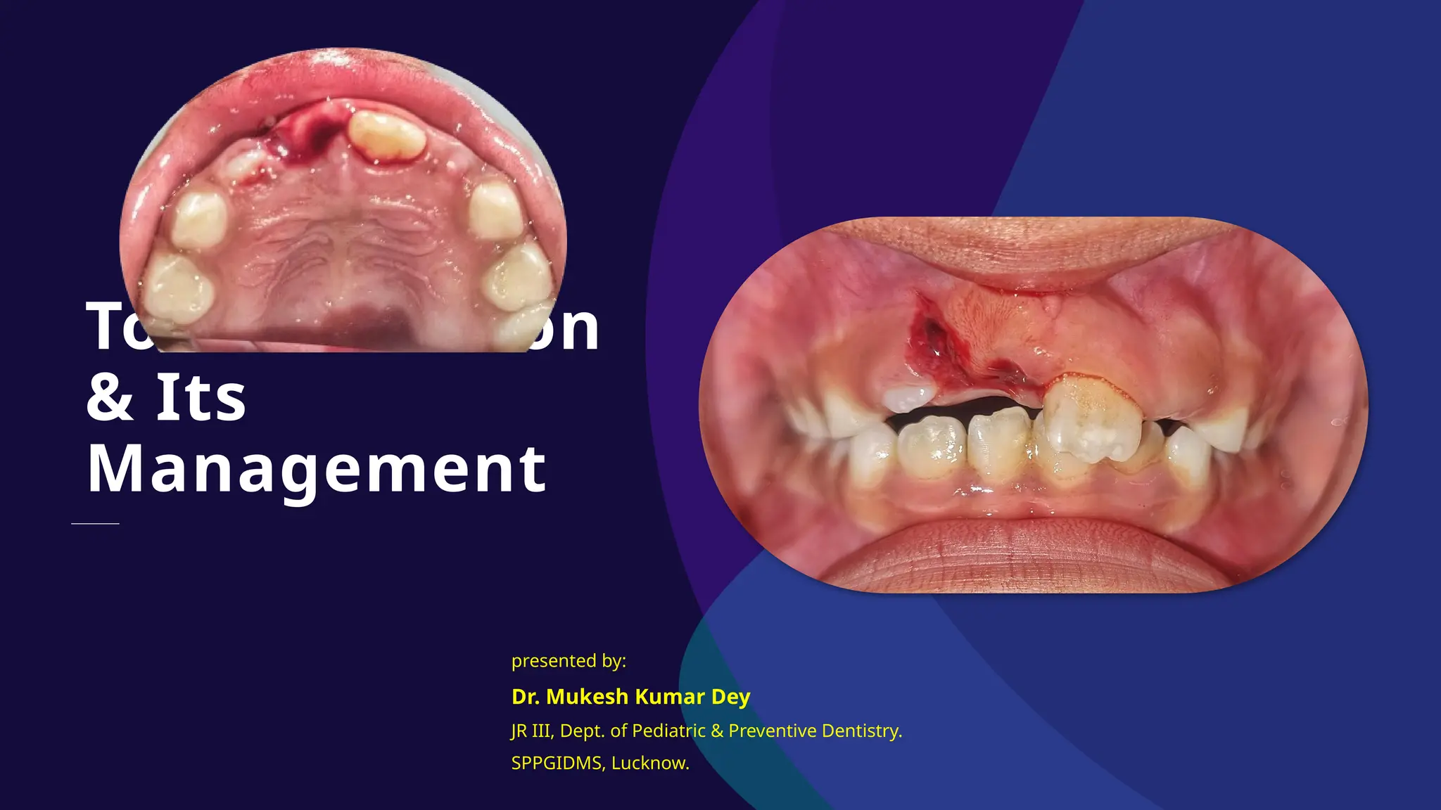 Dental Avulsion & its Management | PPT