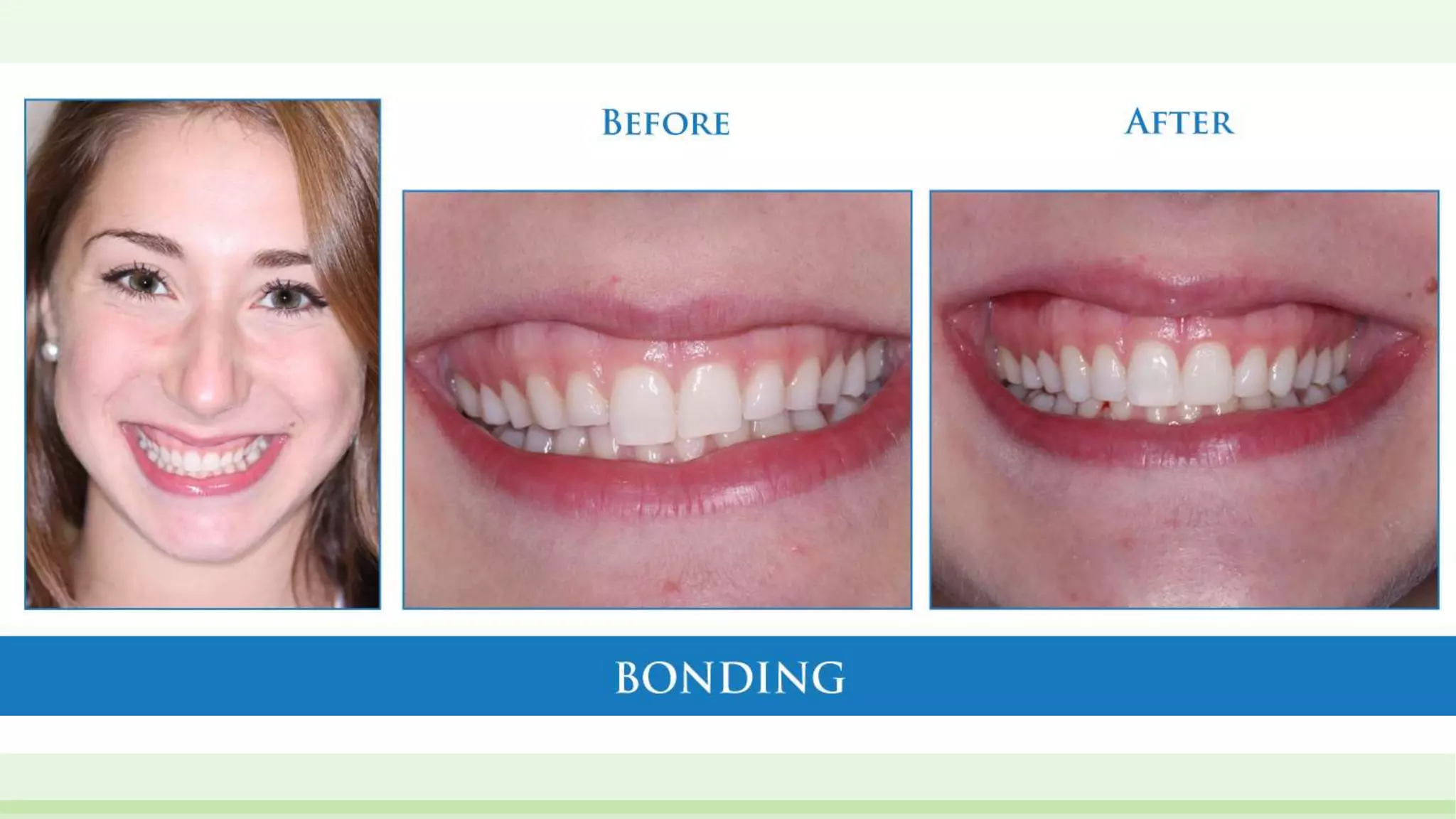 Tooth bonding | PPTX