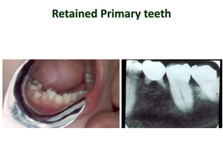 Tooth calcification and eruption.pptx