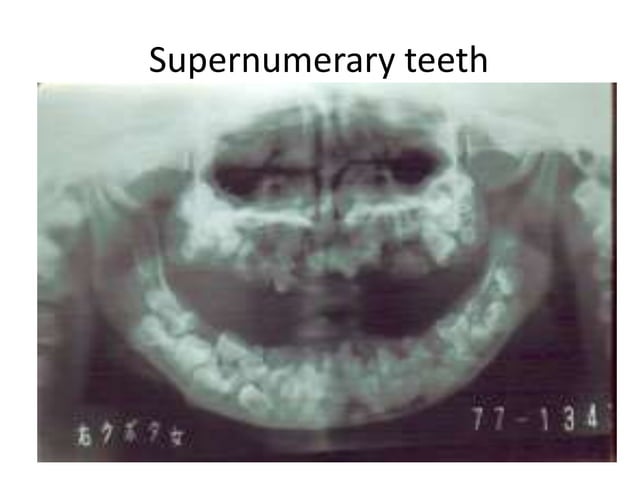 Tooth calcification and eruption.pptx | Oral care | Personal Care