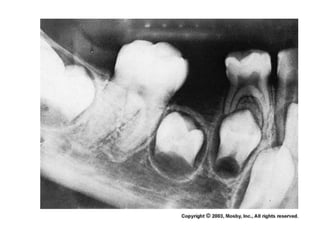 Tooth calcification and eruption.pptx | Oral care | Personal Care