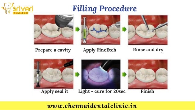 Cavity Filling Process