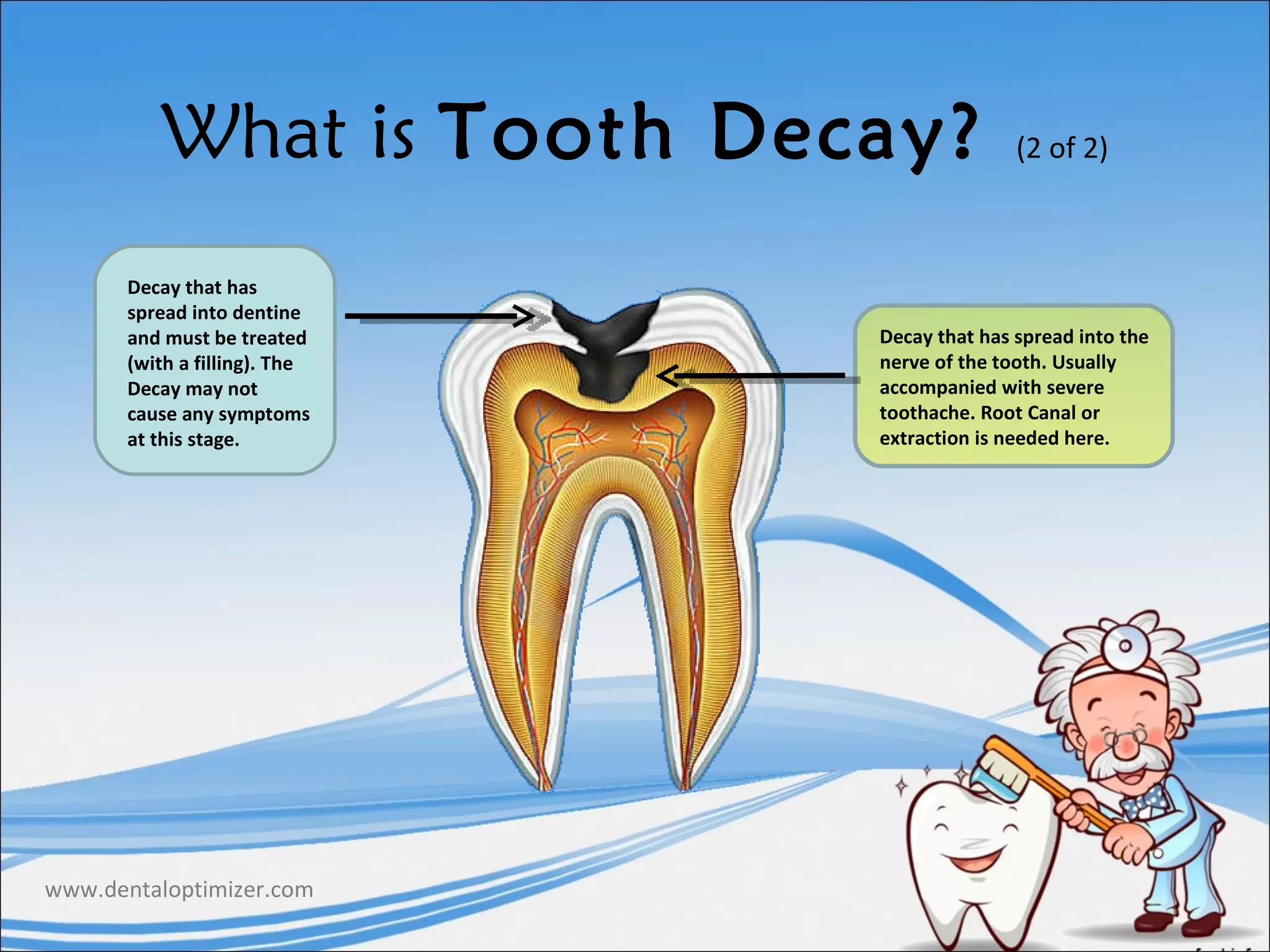 Tooth decayfinal | PPT
