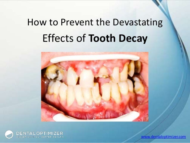 How To Identify and Treat Tooth Decay