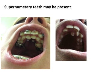Tooth development for the embryology.. | PPT
