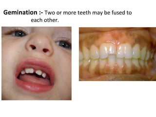 Tooth development for the embryology.. | PPT