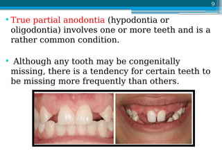 Tooth development disturbances 1.pdf.ppt | Free Download