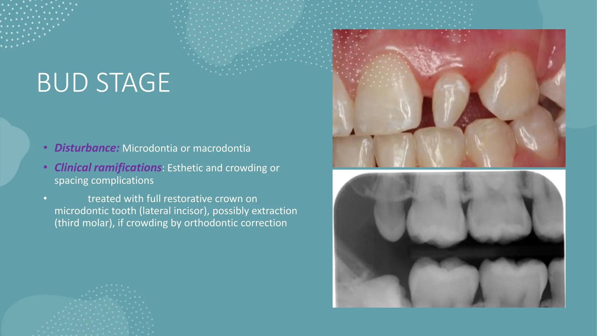 Tooth development along with clinical importance - Oral histology | PPTX