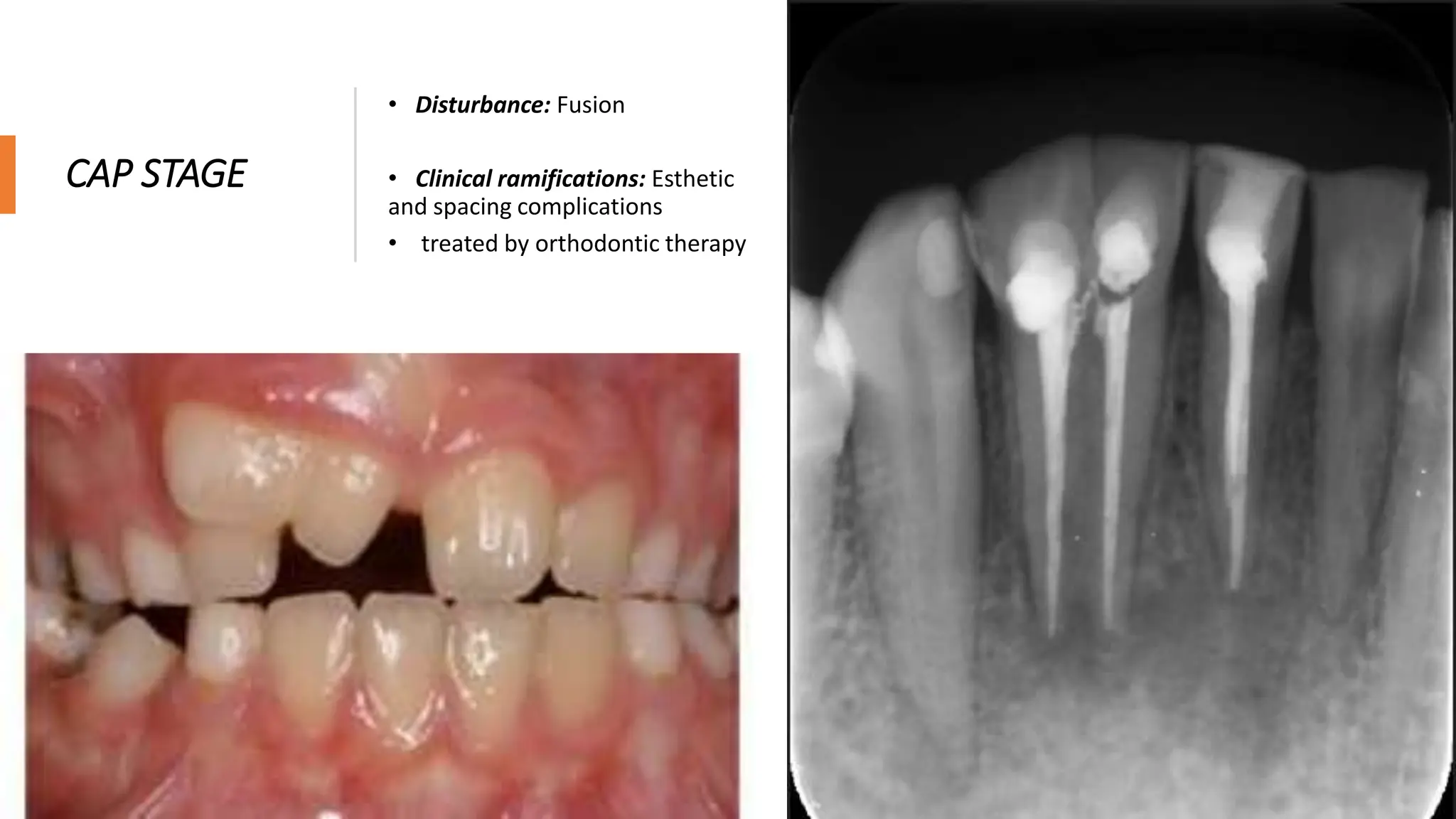 Tooth development along with clinical importance - Oral histology | PPTX
