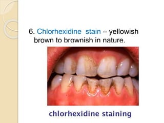 Tooth discoloration | PPTX