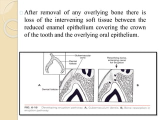 Tooth eruption | PPT