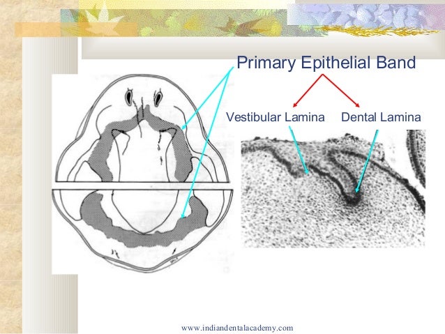 Infratemporal Space Displacement Tooth