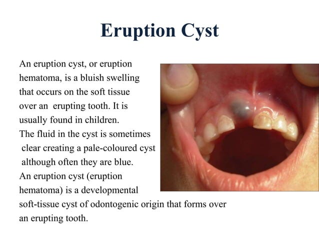 Tooth eruption ppt | PPTX | Dental Health | Diseases and Conditions