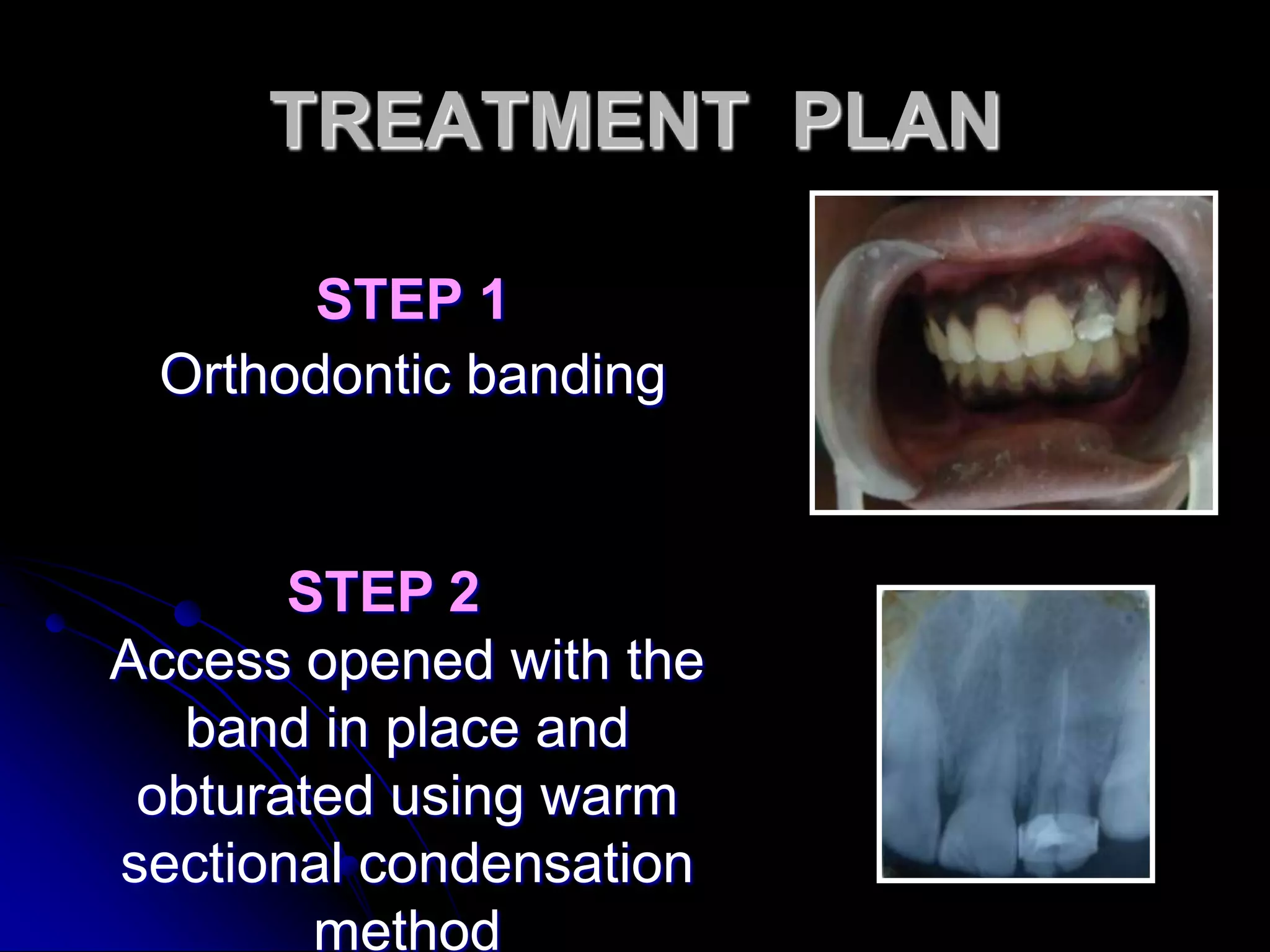 Tooth fractures | PPTX