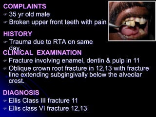Tooth fractures | PPTX