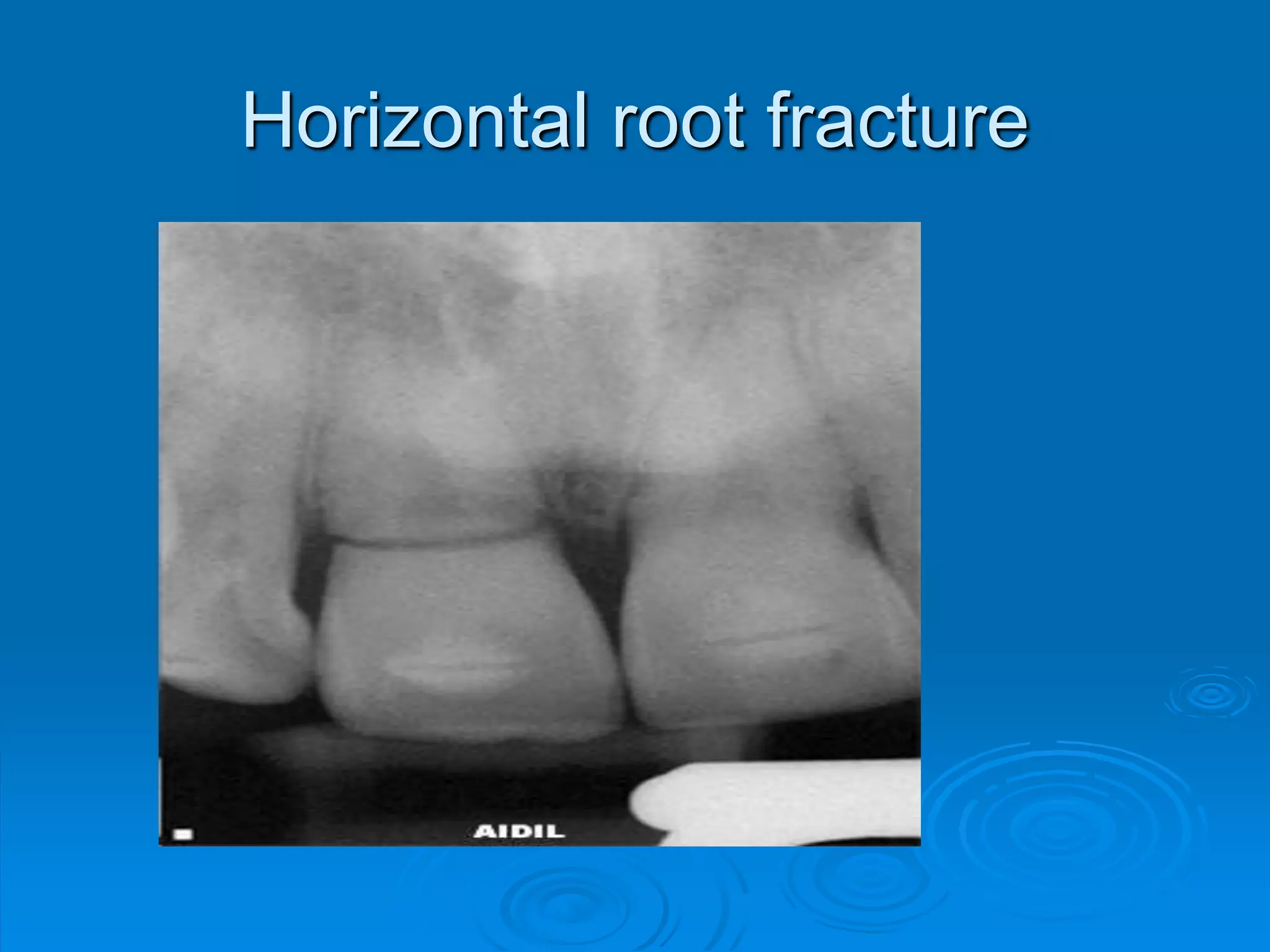 Tooth Fracture Treatment | PPT