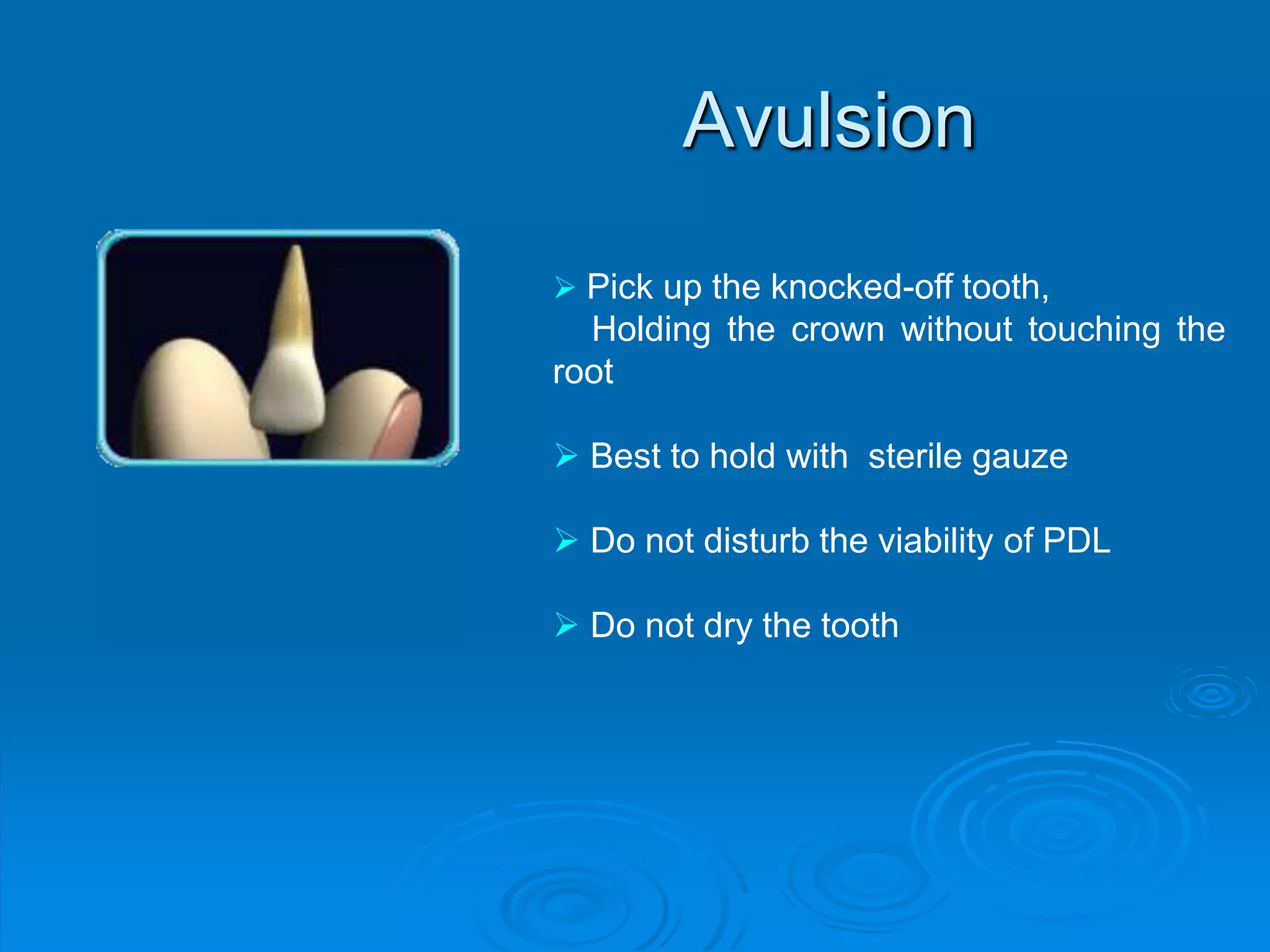 Tooth Fracture Treatment | PPT