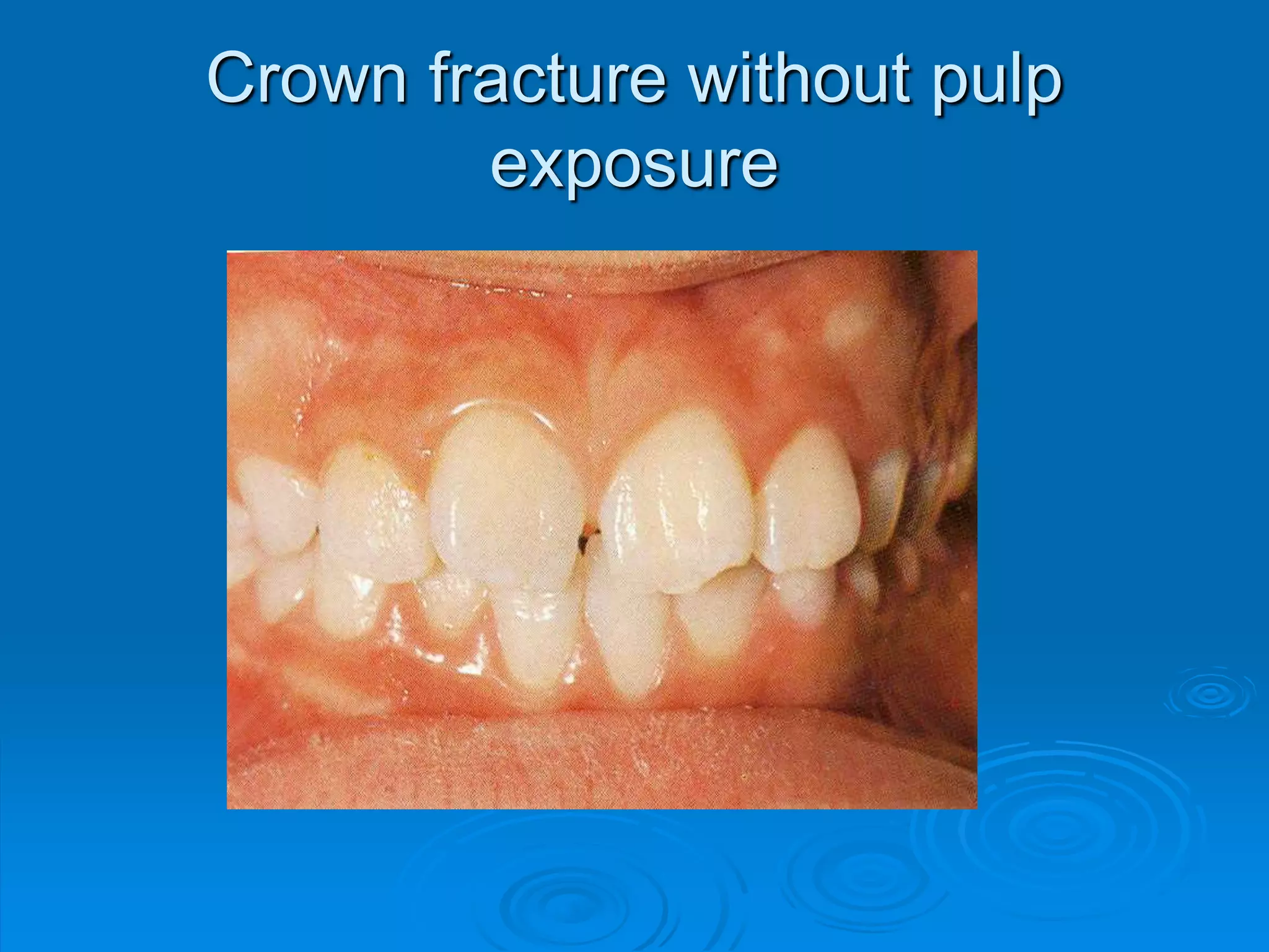 Tooth Fracture Treatment | PPT