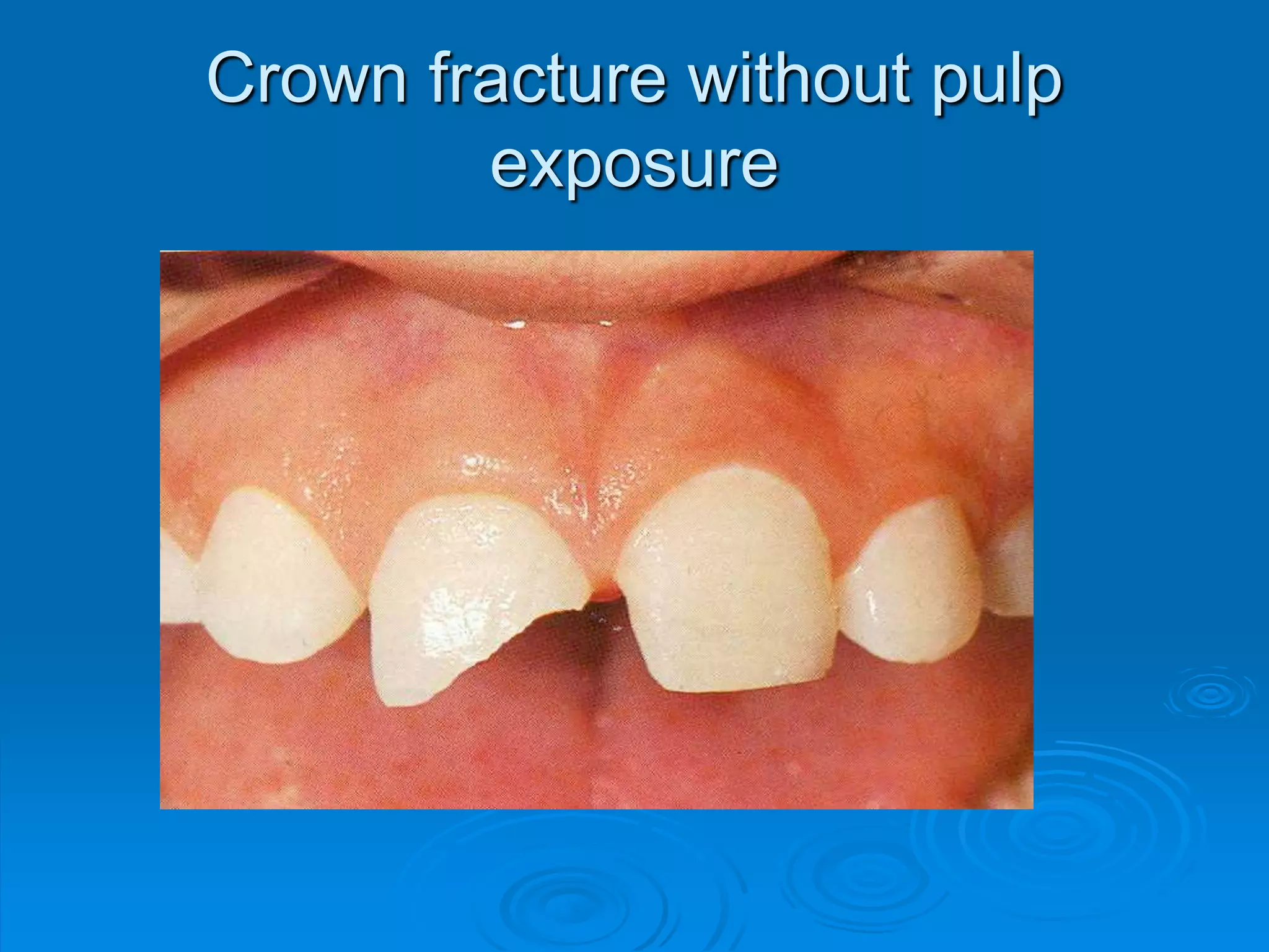 Tooth Fracture Treatment | PPT