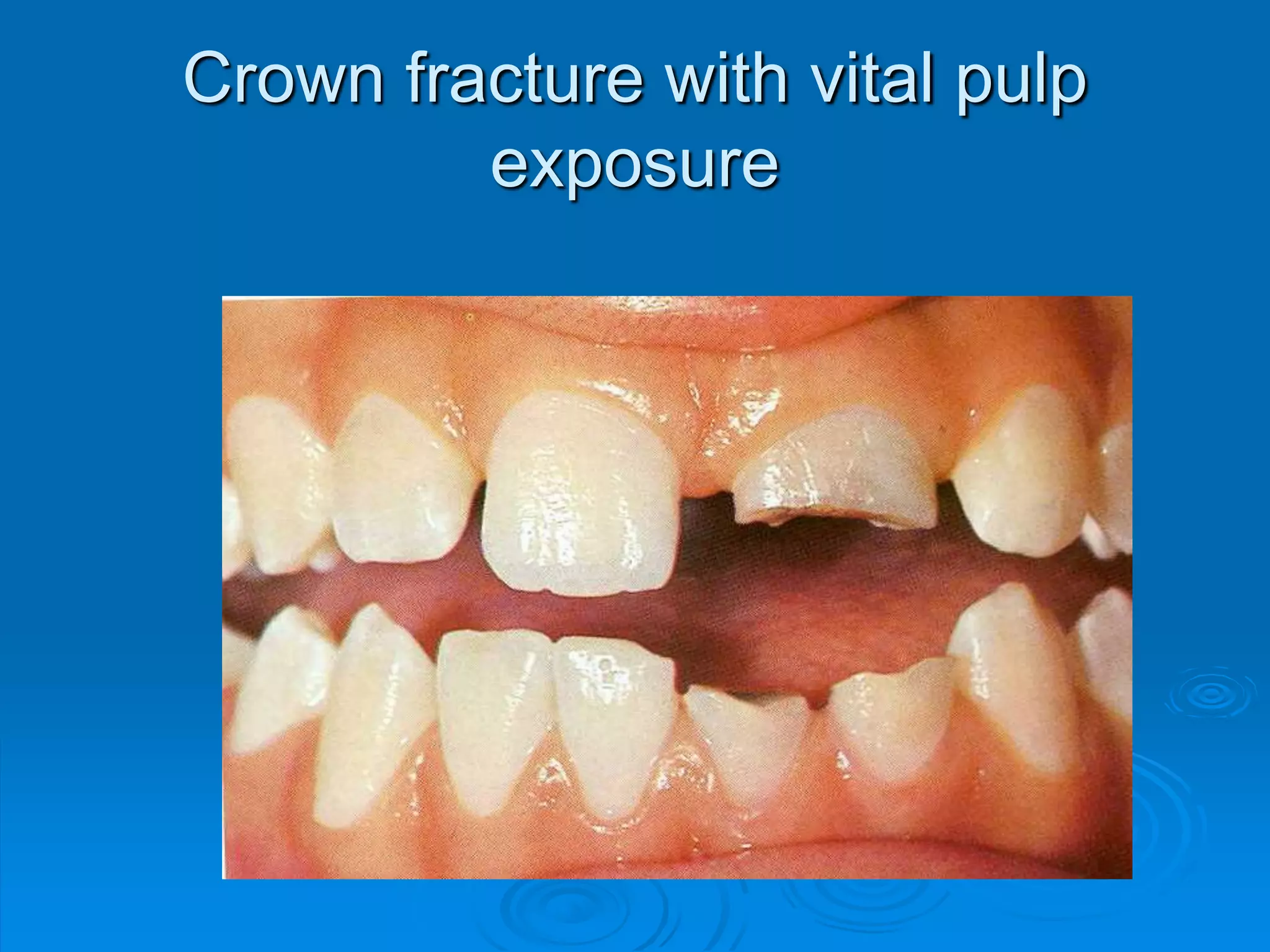 Tooth Fracture Treatment | PPT
