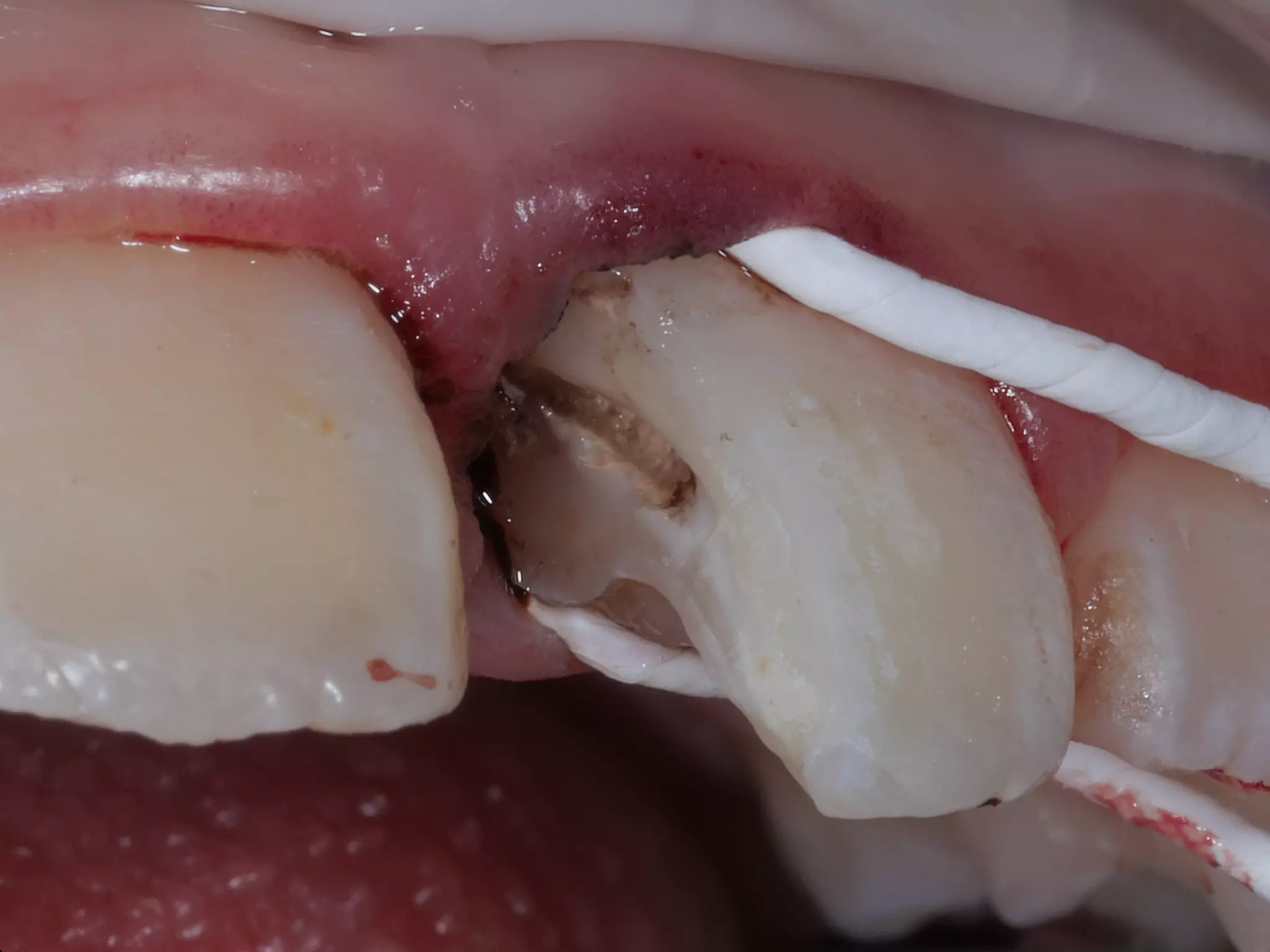 Tooth fragment reattachment and vital pulp therapy | PDF