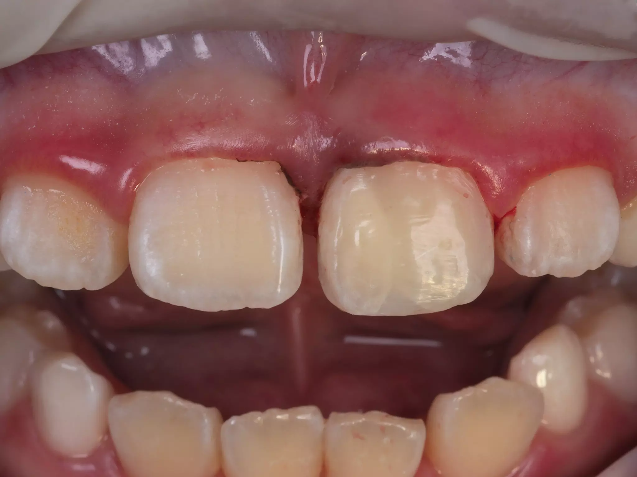 Tooth fragment reattachment and vital pulp therapy | PDF