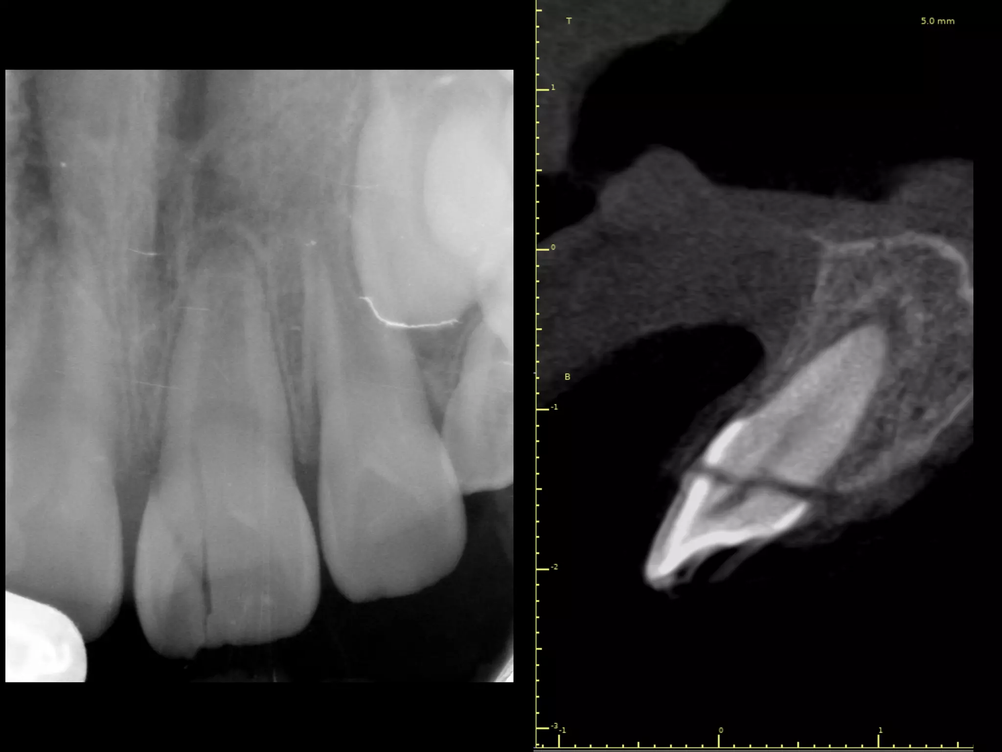 Tooth fragment reattachment and vital pulp therapy | PDF