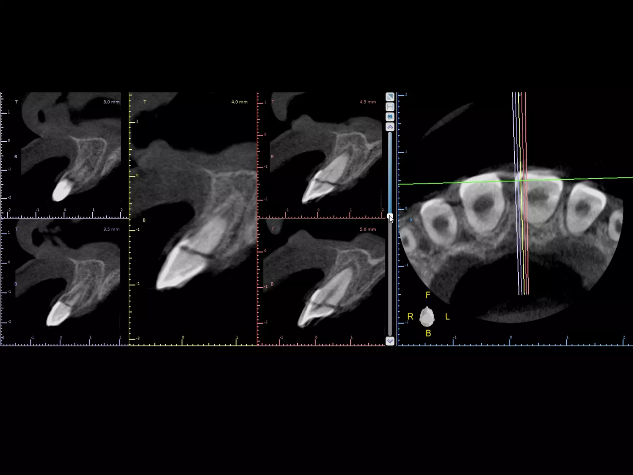 Tooth fragment reattachment and vital pulp therapy | PDF